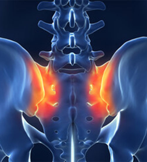 Sacroiliac Pain - Get Rid Of That Pain In The Butt For Good